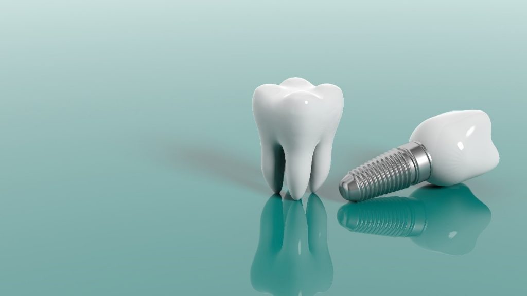 Dental Implants 101: Common Terms You Should Know